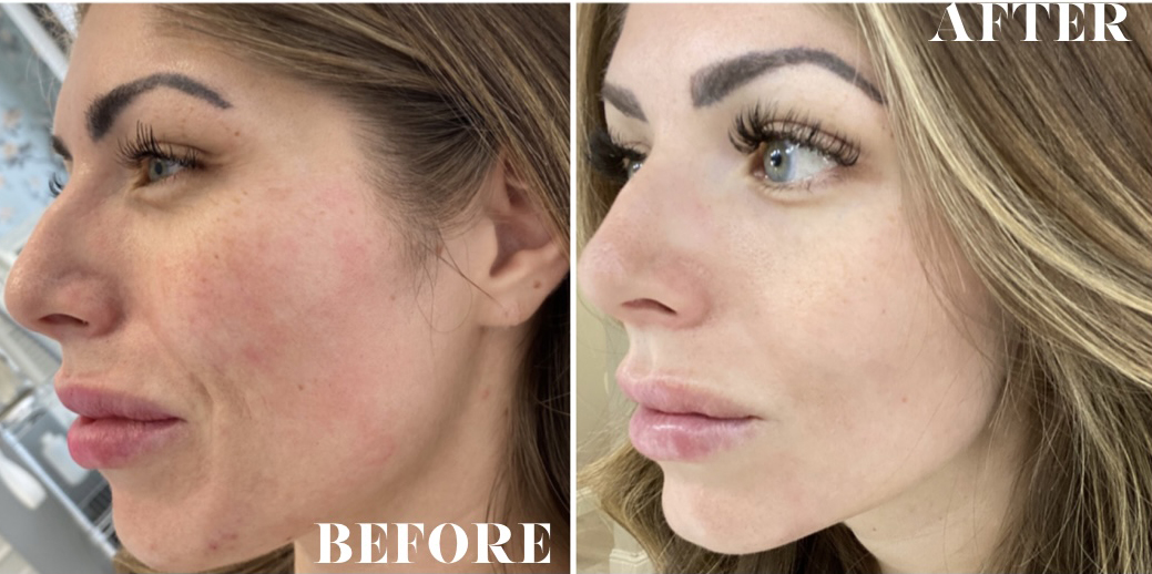 Vampire Facial - EUROPHORIA Medical and Personal Spa in Bakersfield ...