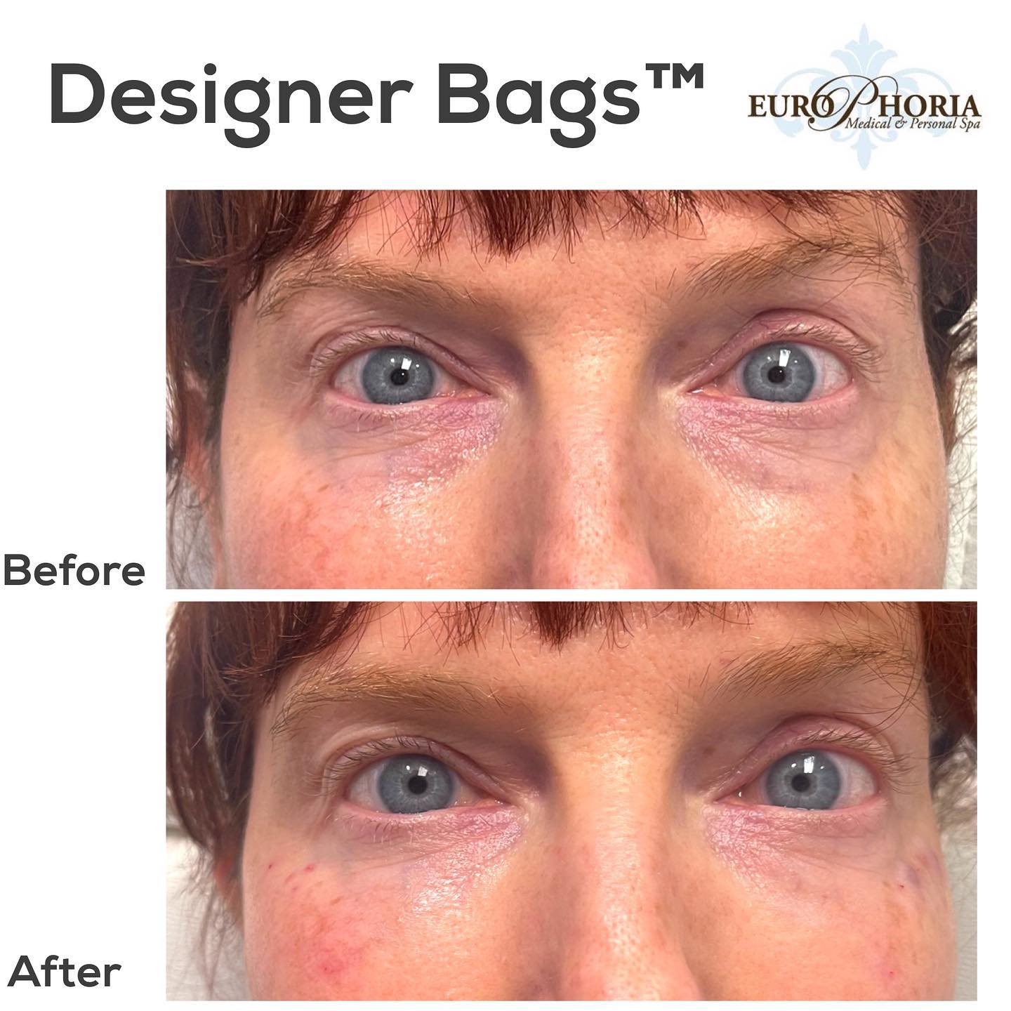 Patient 104026912 | Designer Bags™ Before & After Photos | EuroPhoria
