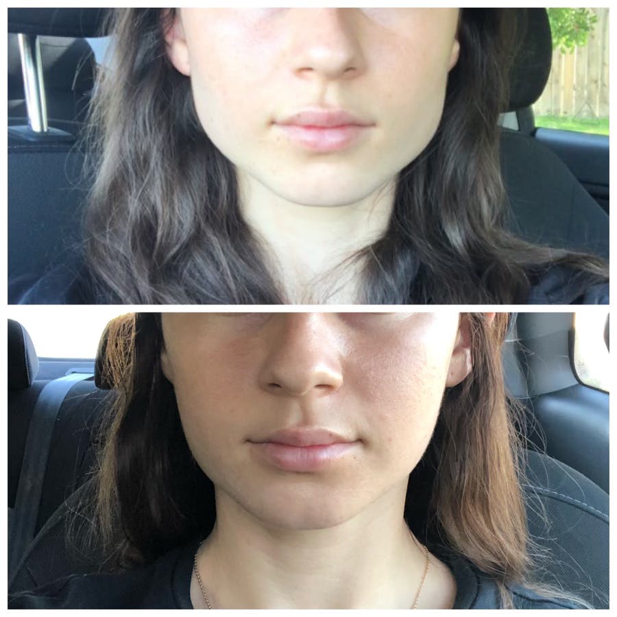 Patient 145034031 | Wrinkle Relaxers Before & After Photos | EuroPhoria