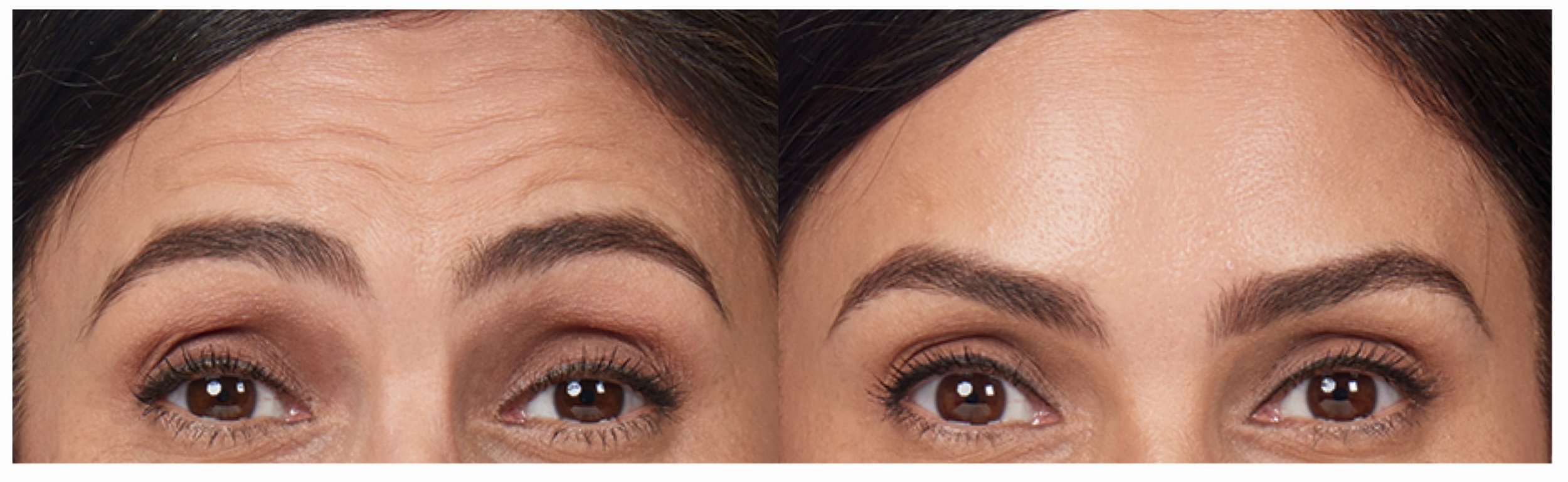 Botox & Dysport Before & After Photos | Face Forward Medical Aesthetics
