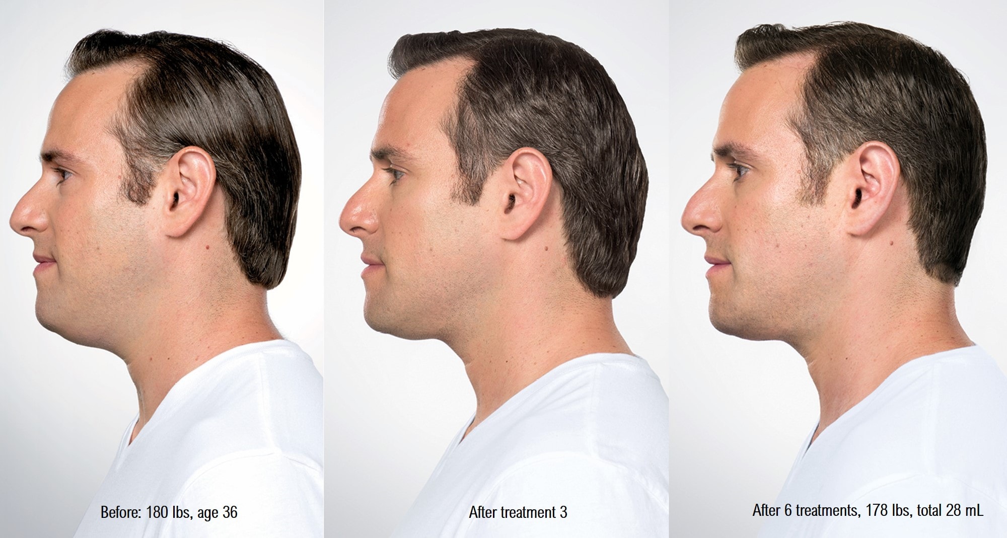 Kybella Before & After Photos | Face Forward Medical Aesthetics