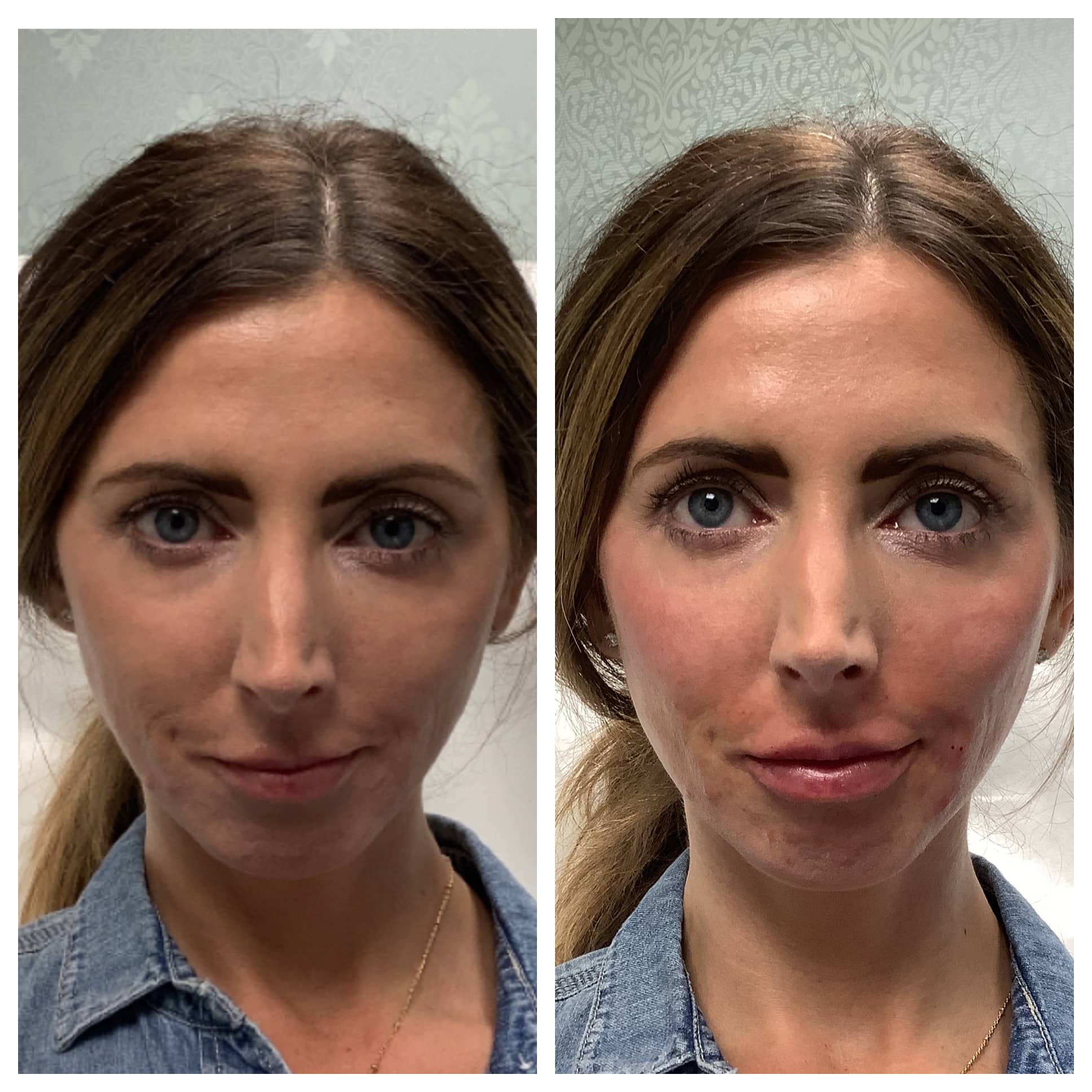Dermal Filler Before & After Photos | Face Forward Medical Aesthetics