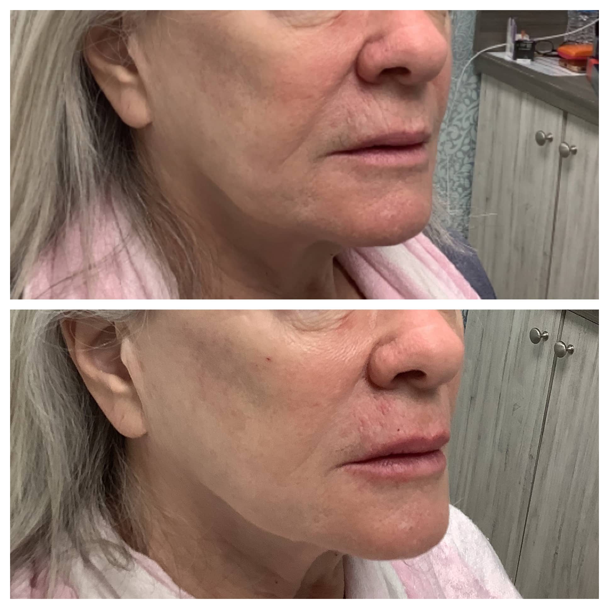 Dermal Filler Before & After Photos | Face Forward Medical Aesthetics