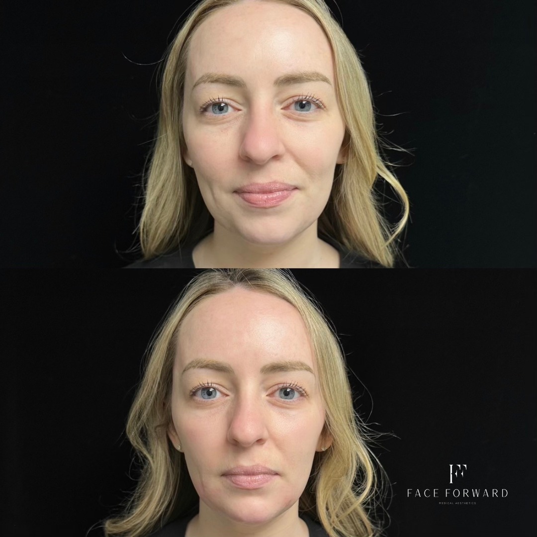 Dermal Filler Before & After Photos | Face Forward Medical Aesthetics