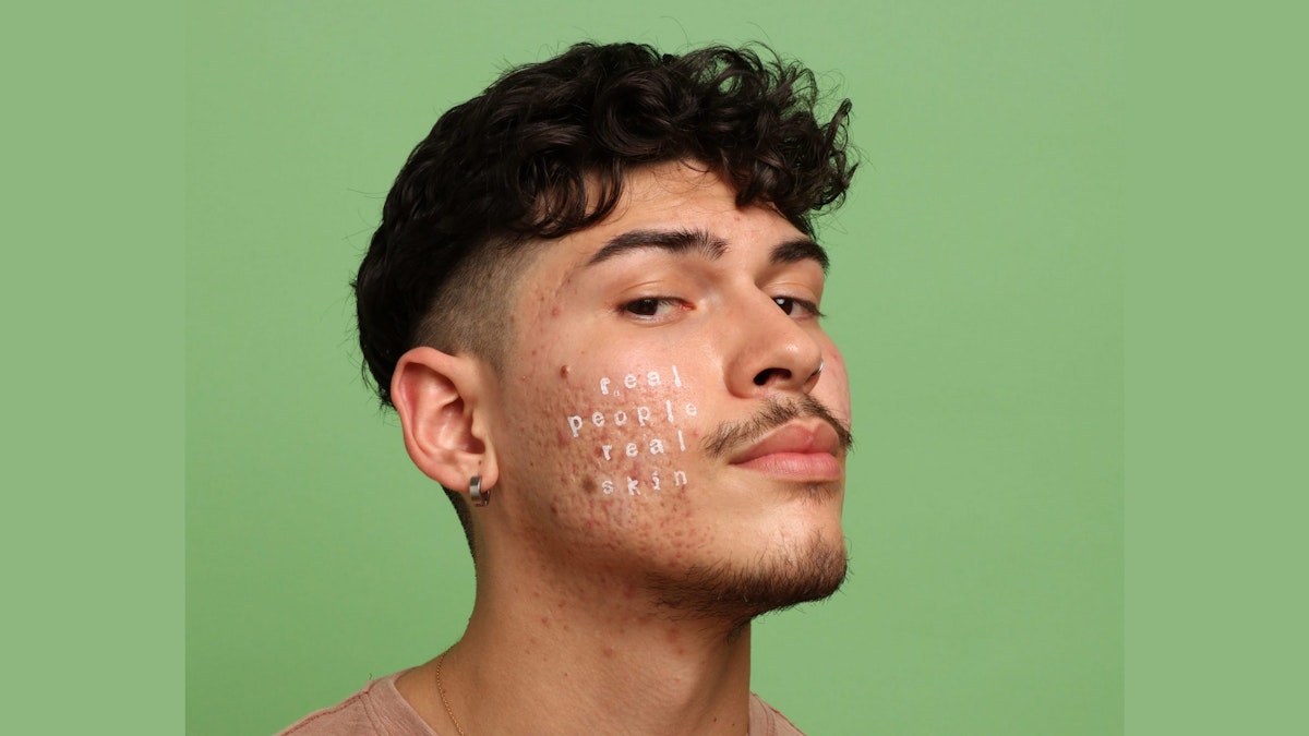 The causes and treatment of acne, and the power of skin acceptance