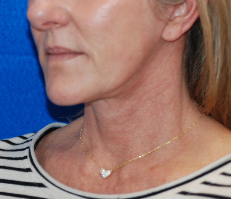 Patient 324704 Facelift Before And After Photos Mary Lynn Moran Md