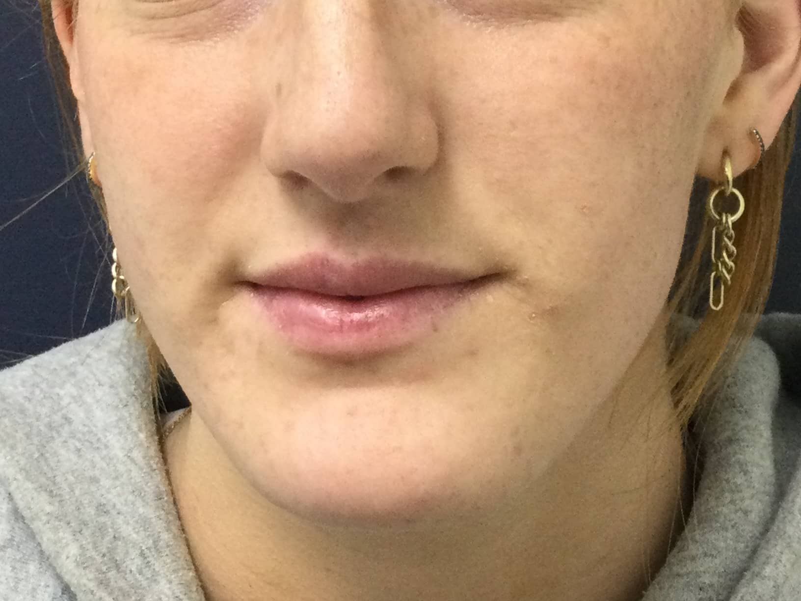 Restylane® Before & After Photos | Ponte Vedra Plastic Surgery