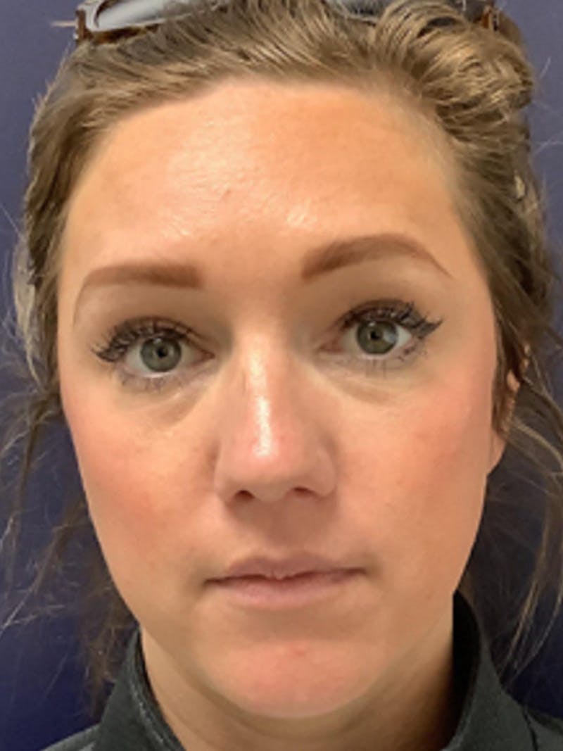 Patient 148394420 | Jennifer Thurman-Olivieri, APRN Before & After ...