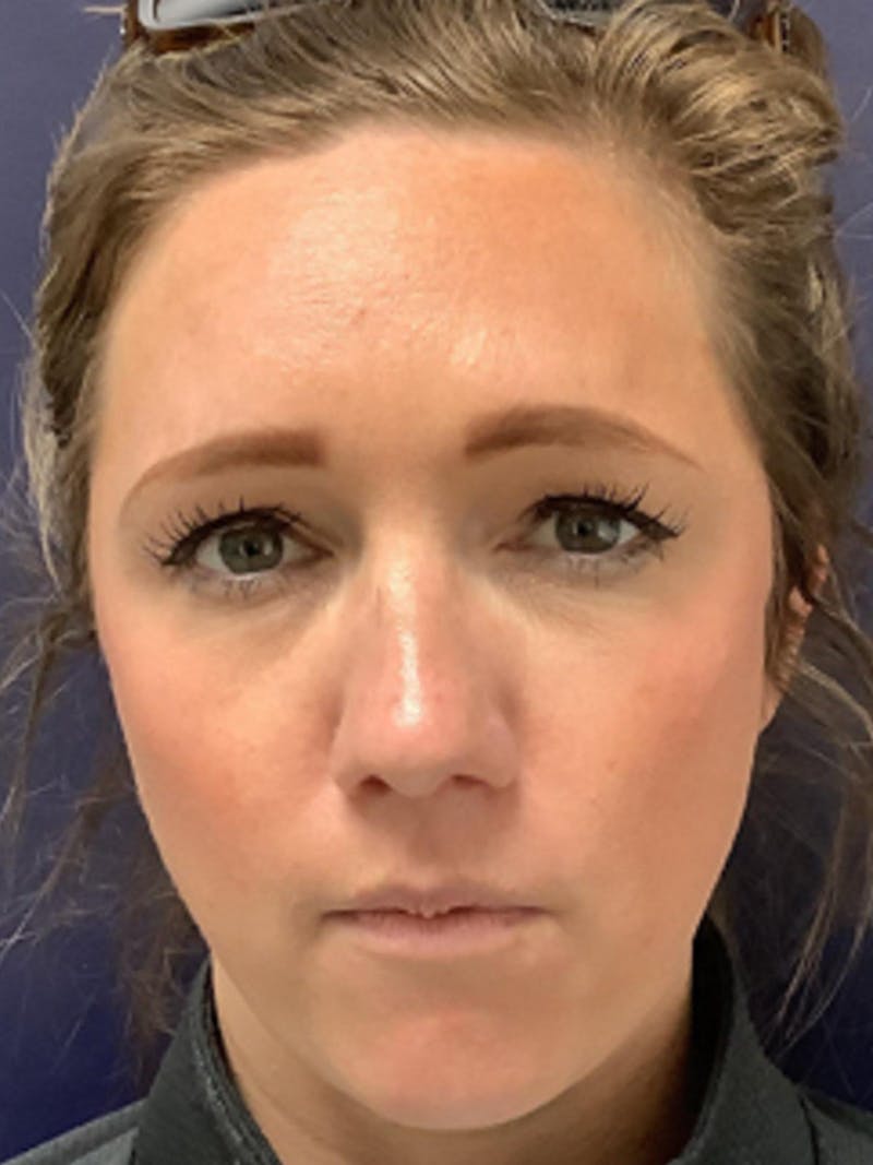 Patient 148394420 | Jennifer Thurman-Olivieri, APRN Before & After ...