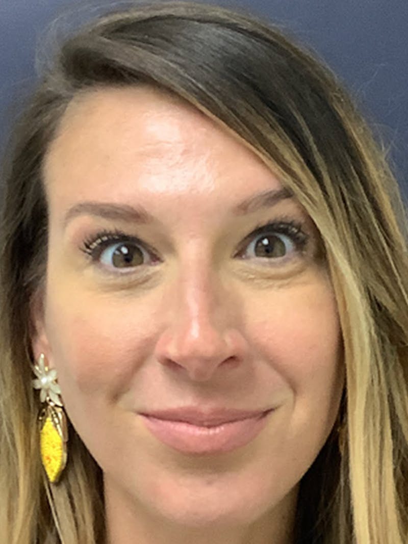 Patient 148394422 | Jennifer Thurman-Olivieri, APRN Before & After ...