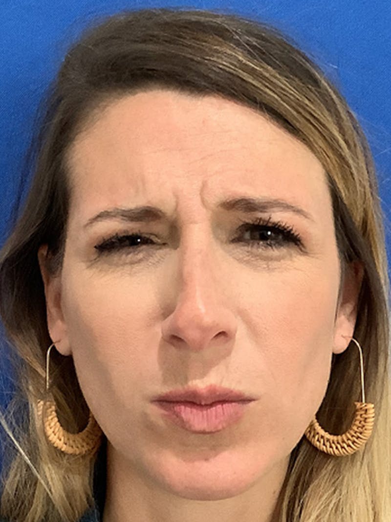 Patient 148394422 | Jennifer Thurman-Olivieri, APRN Before & After ...