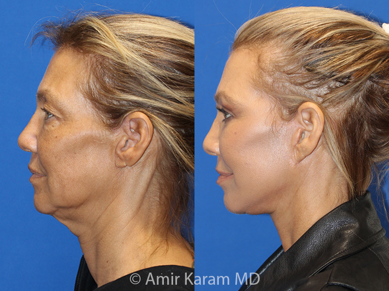 Patient 71700587 | Vertical Restore® / Facial Rejuvenation Before ...