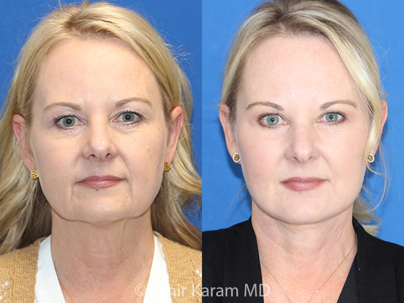 Patient 71700602 | Vertical Restore® / Facial Rejuvenation Before ...