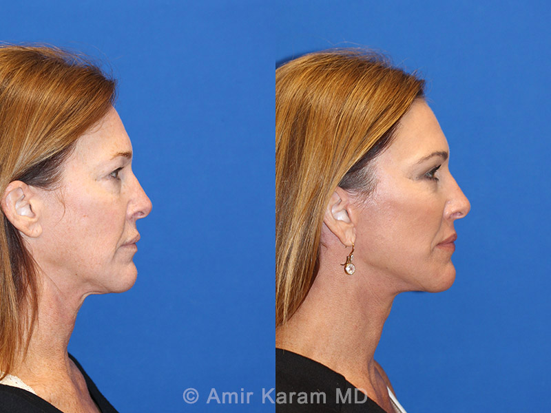 Patient 71700632 | Vertical Restore® / Facial Rejuvenation Before ...