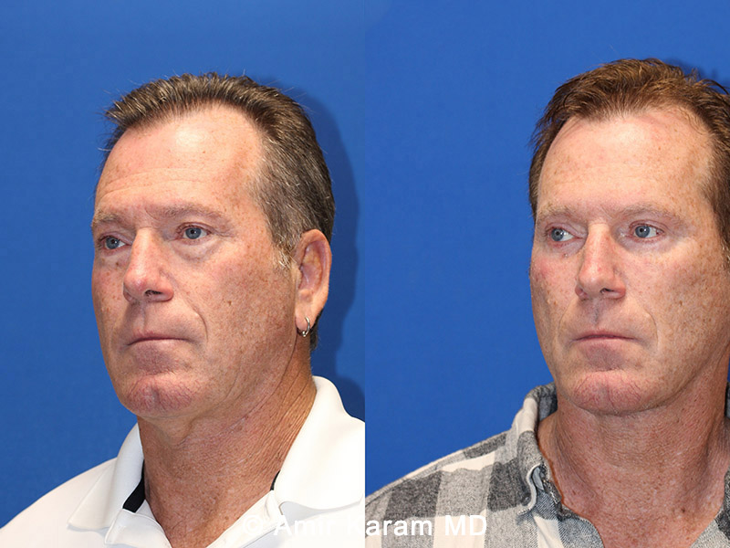 Patient 71700635 | Vertical Restore® / Facial Rejuvenation Before ...