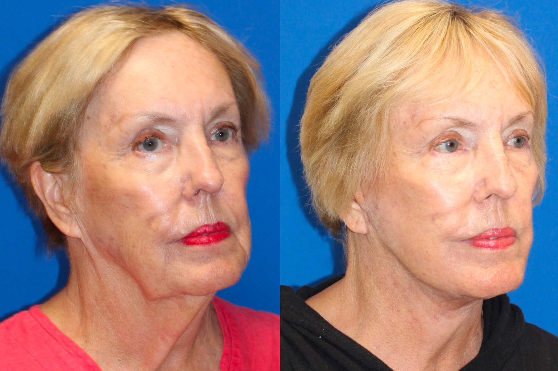 Patient 71700768 | Vertical Restore® / Facial Rejuvenation Before ...