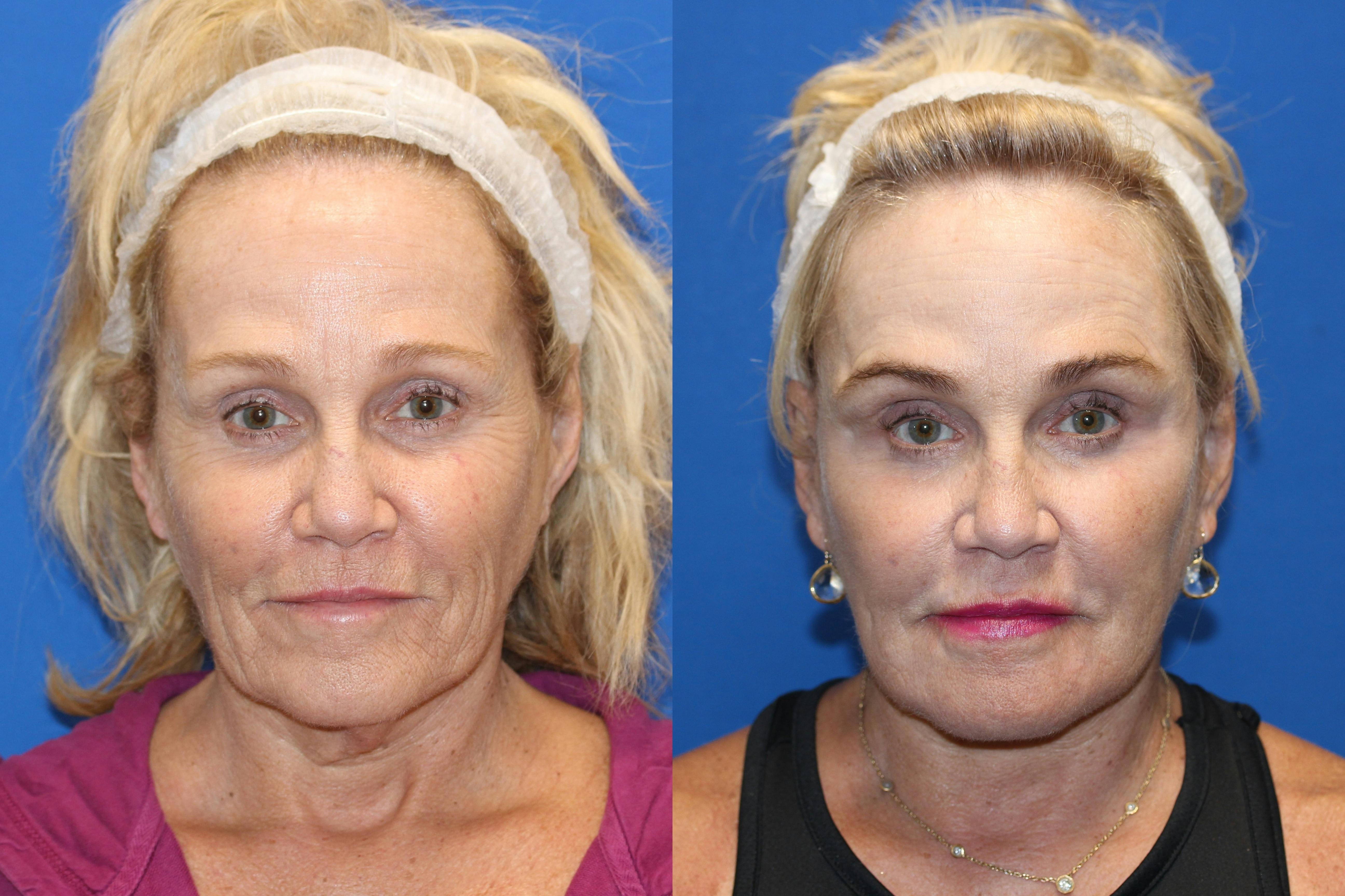 Patient 89289860 | Fat Transfer Before & After Photos | Carmel Valley ...