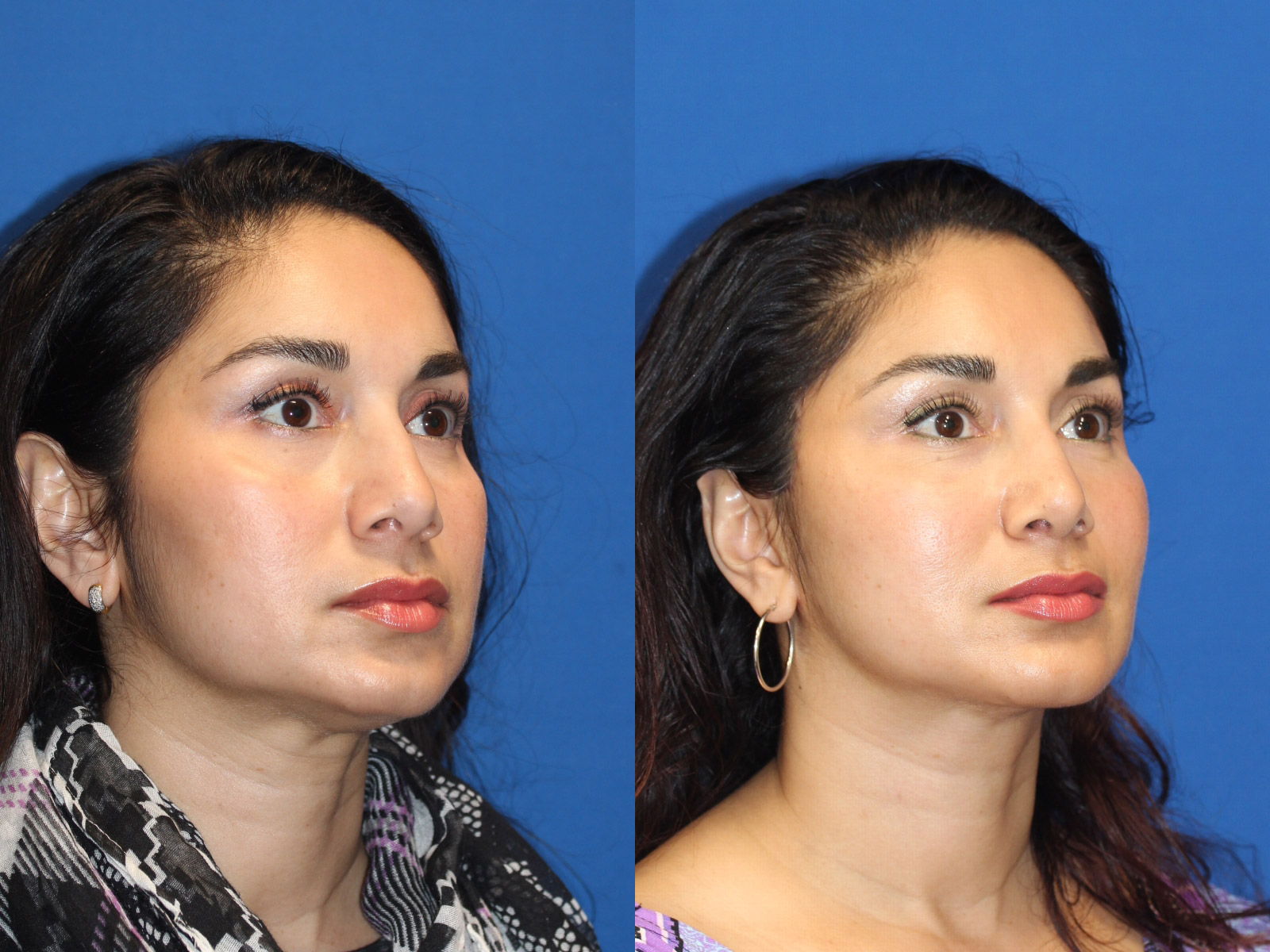Patient 71701613 | Neck Lift Before & After Photos | Carmel Valley ...