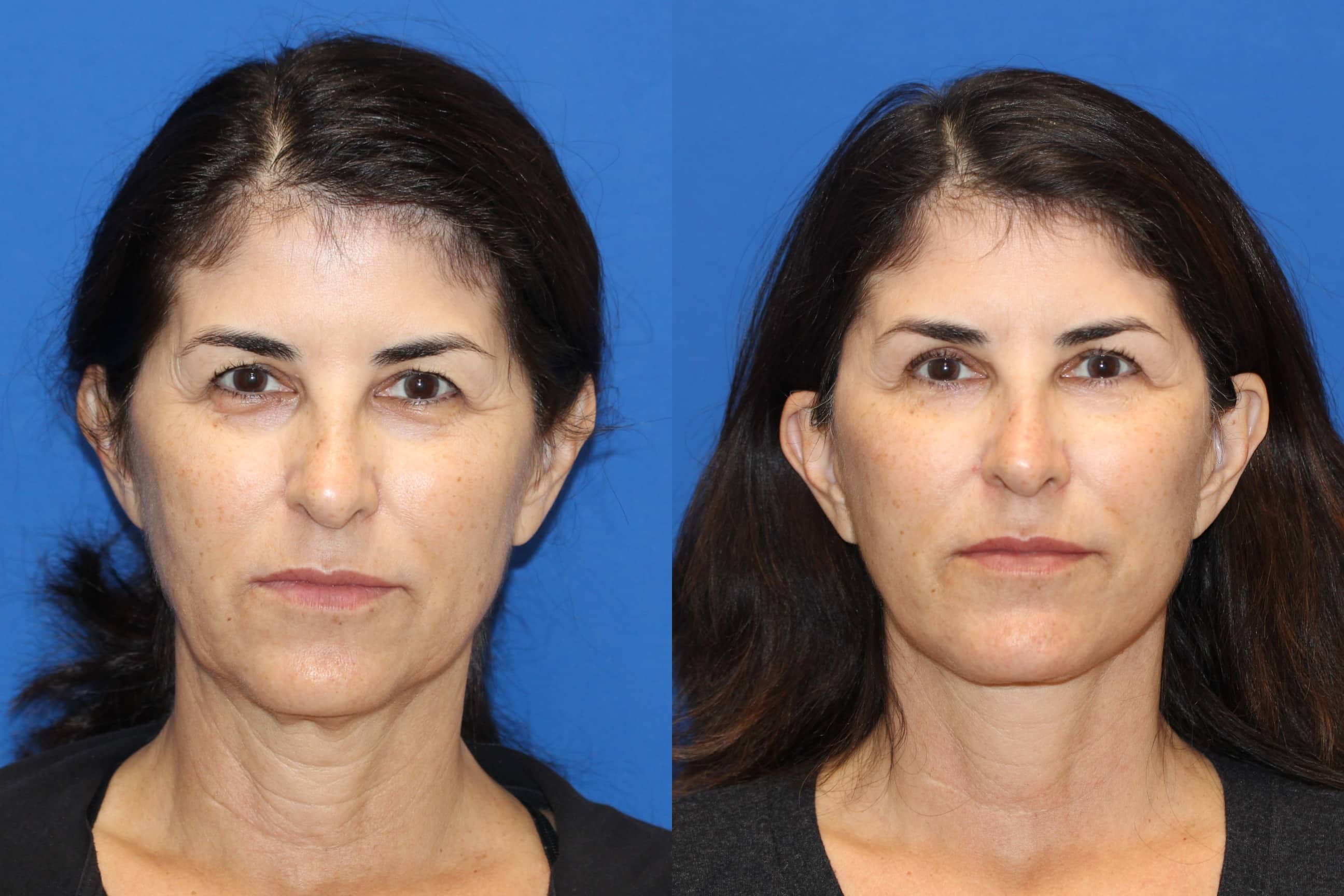Patient 102564156 | Vertical Restore® / Facial Rejuvenation Before ...
