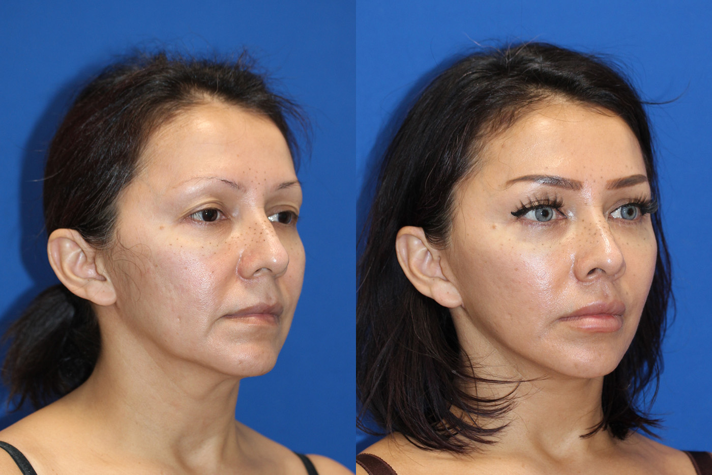 Patient 153265680 | Vertical Restore® / Facial Rejuvenation Before ...