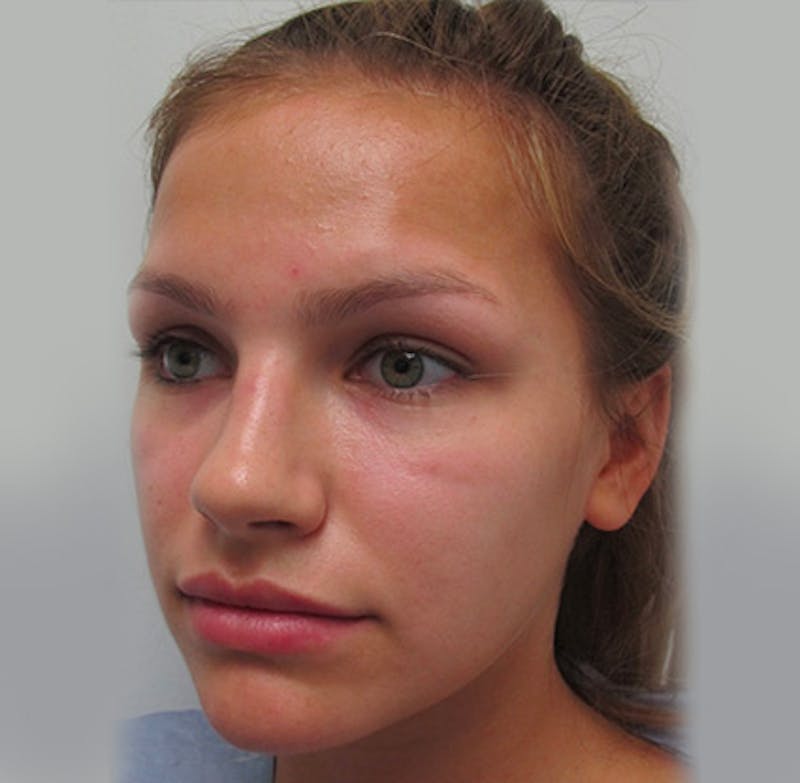 Patient 122908643 | Nasal Fracture Before & After Photos | Lampert Md ...