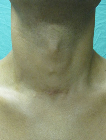 Tracheostomy Scar Revision