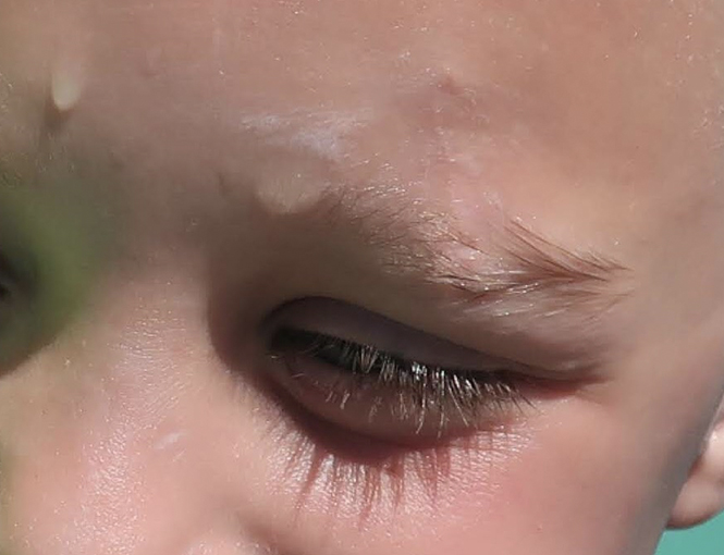 Scar Revision Before & After Photos | Dr. Shari Reitzen, MD ENT ...