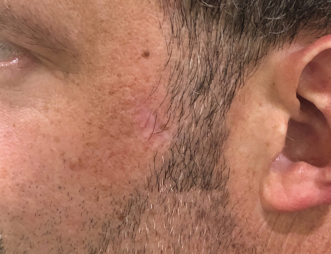 Scar Revision Before & After Photos | Dr. Shari Reitzen, MD ENT ...