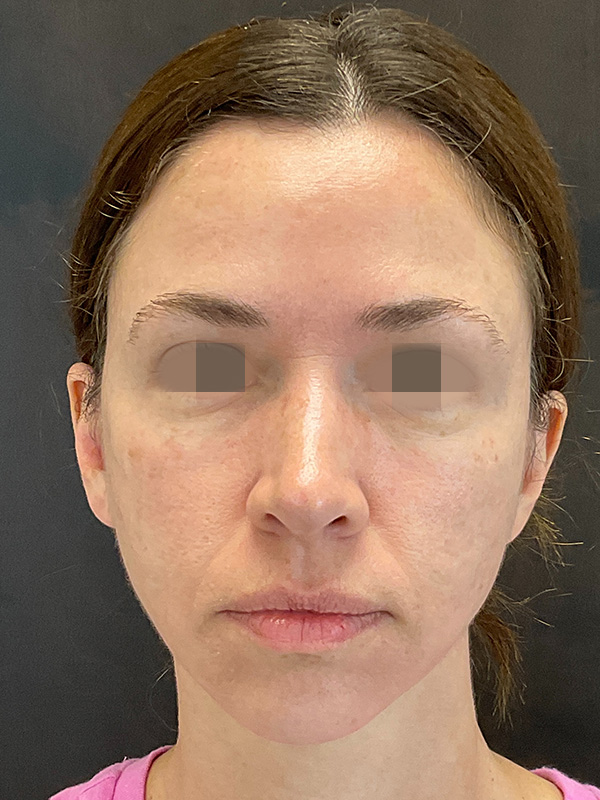 Patient 131838948 | Full Face Filler Before & After Photos | Highwater ...