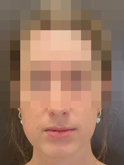 Full Face Filler Before & After Photos | Highwater Aesthetics