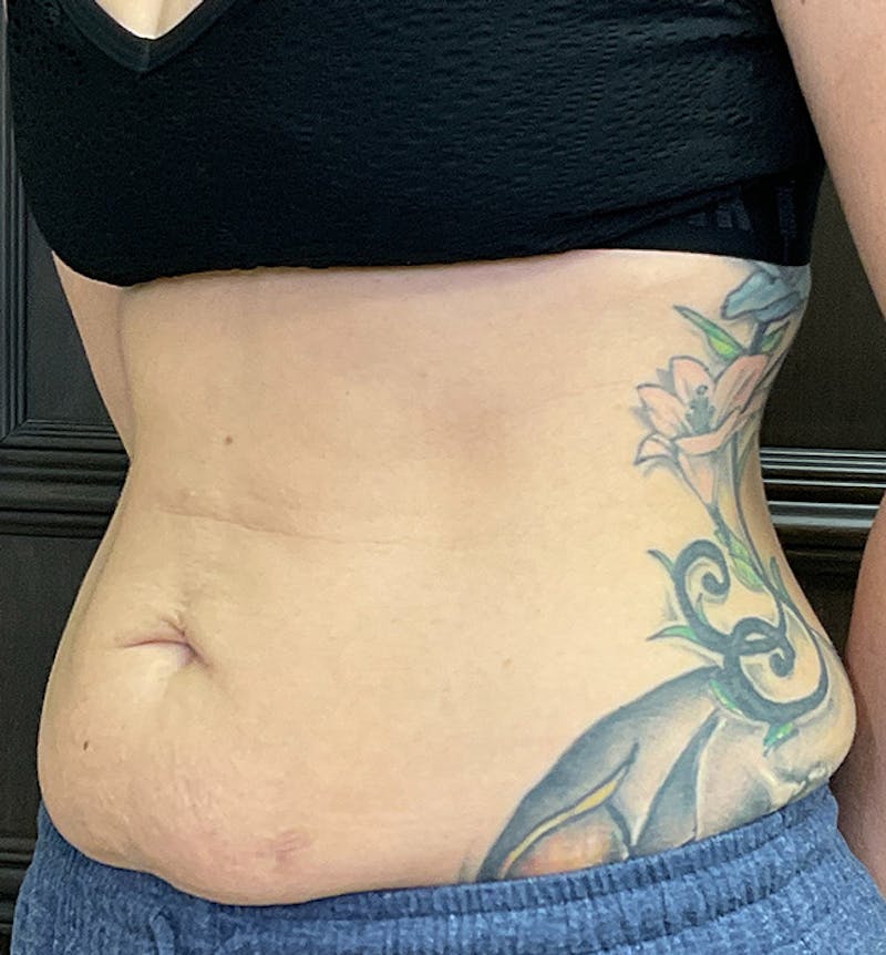 Patient 147614701 Semaglutide Before And After Photos Highwater
