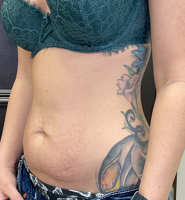 Patient 147614701 Semaglutide Before And After Photos Highwater
