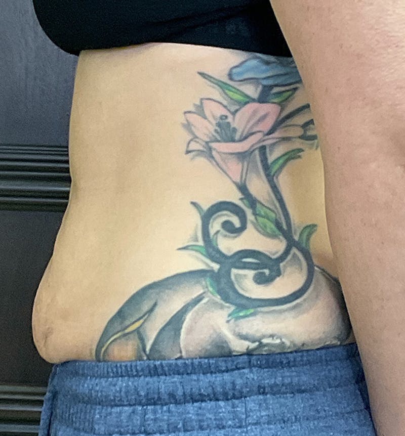 Patient 147614701 Semaglutide Before And After Photos Highwater