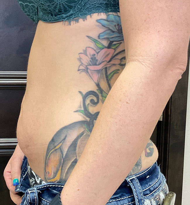 Patient 147614701 Semaglutide Before And After Photos Highwater