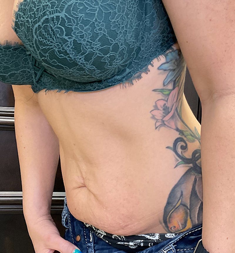Patient 147614701 Semaglutide Before And After Photos Highwater