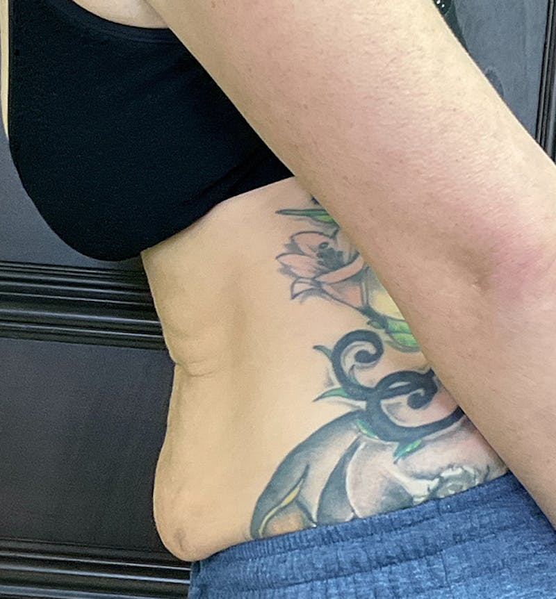 Patient 147614701 Semaglutide Before And After Photos Highwater