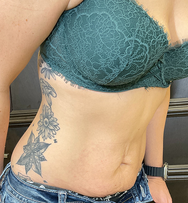 Patient 147614701 Semaglutide Before And After Photos Highwater
