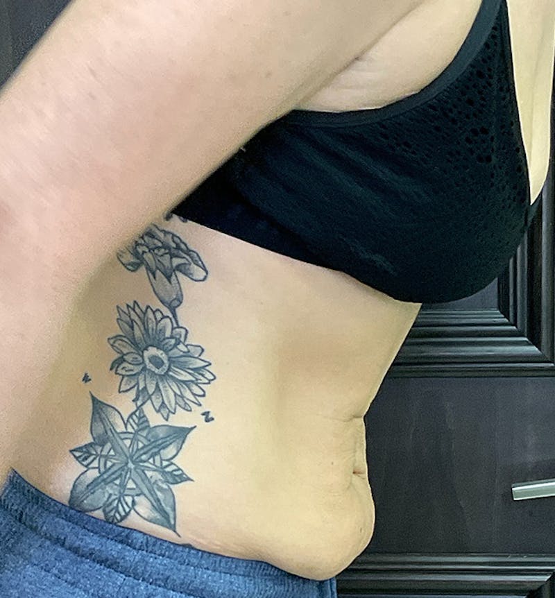 Patient 147614701 Semaglutide Before And After Photos Highwater