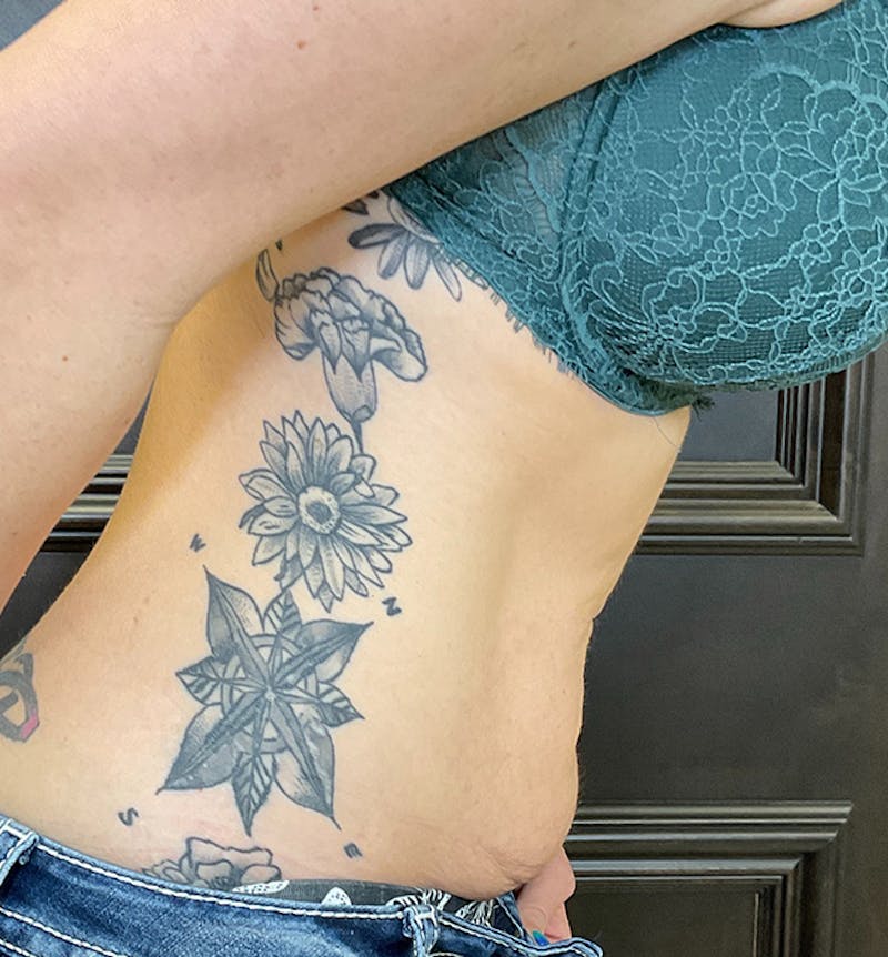 Patient 147614701 Semaglutide Before And After Photos Highwater