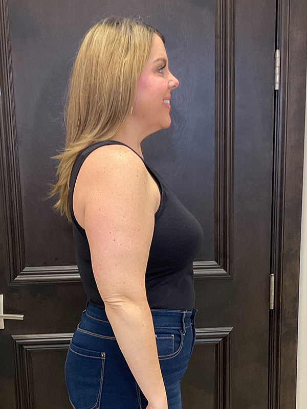 Patient 147614844 | Semaglutide Before & After Photos | Highwater ...