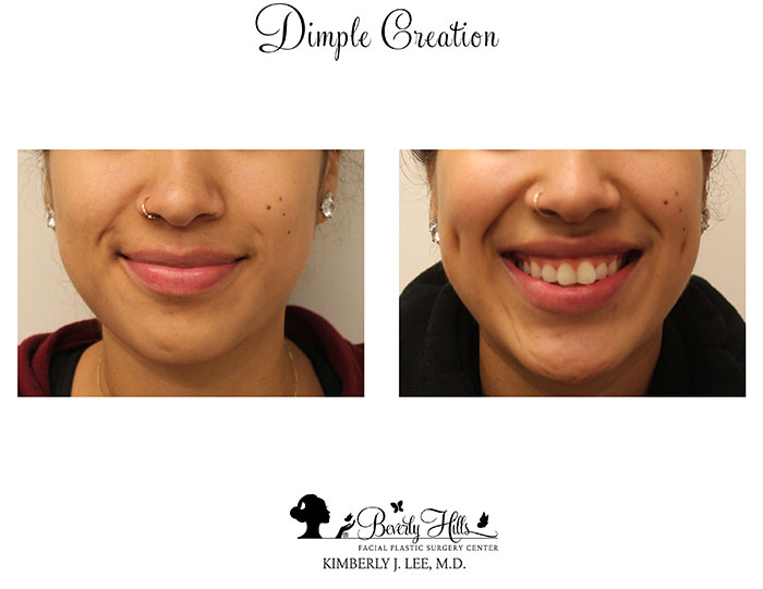 Dimple Creation Before & After Photos | Dr. Kimberly Lee