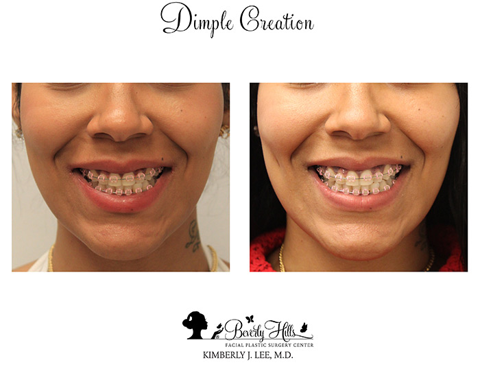 Dimple Creation Before & After Photos | Dr. Kimberly Lee