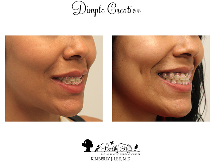 Dimple Creation Before & After Photos | Dr. Kimberly Lee
