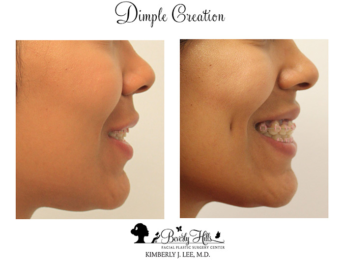 Dimple Creation Before & After Photos | Dr. Kimberly Lee