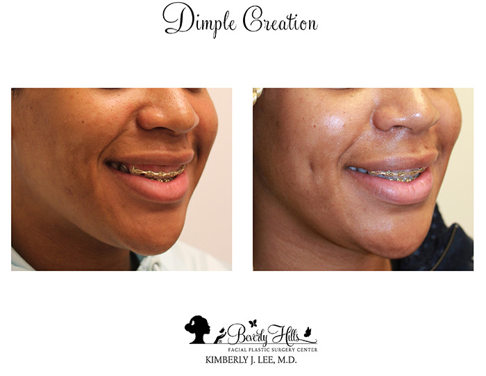 Dimple Creation Before & After Photos | Dr. Kimberly Lee