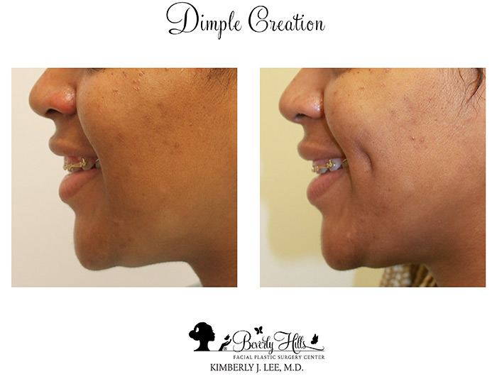 Dimple Creation Before & After Photos | Dr. Kimberly Lee
