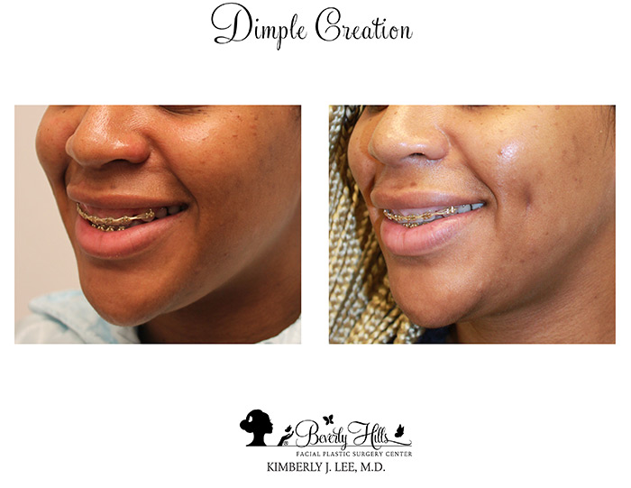 Dimple Creation Before & After Photos | Dr. Kimberly Lee