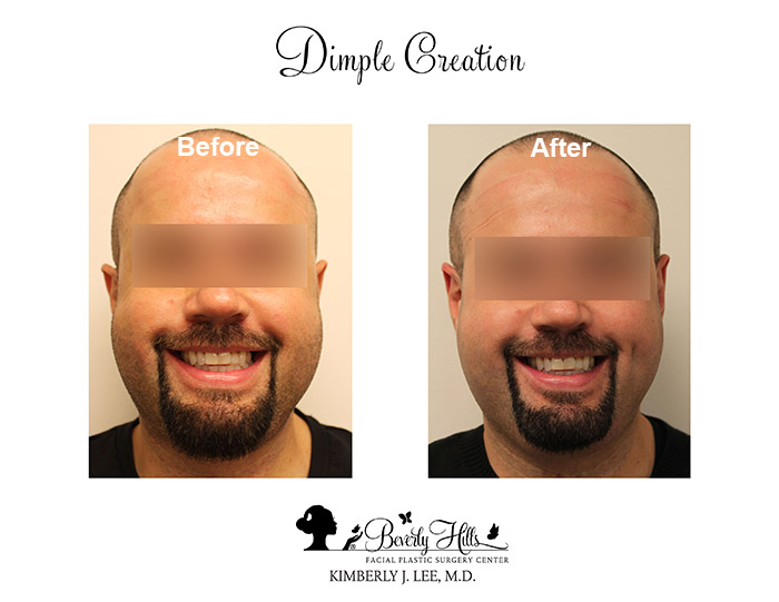 Dimple Creation Before & After Photos | Dr. Kimberly Lee