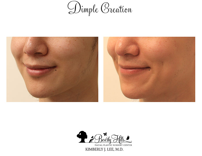 Dimple Creation Before & After Photos | Dr. Kimberly Lee
