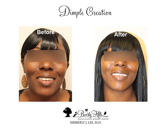 Dimple Creation Before & After Photos | Dr. Kimberly Lee